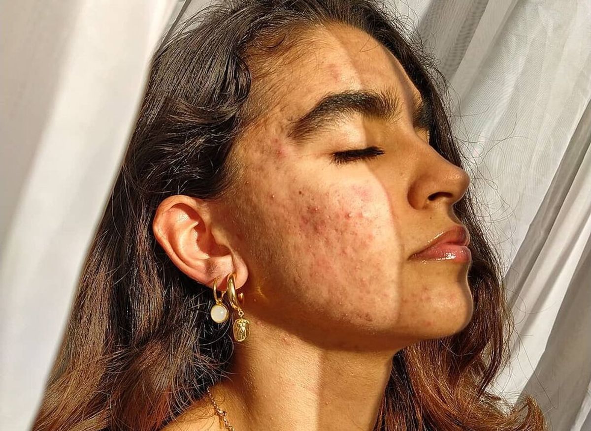 Acné positive : les influenceuses qui brisent le tabou de l'acné ...